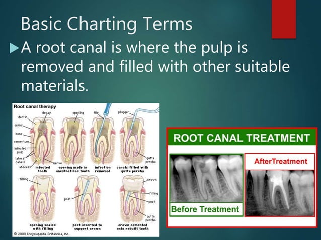 Dental charting, Cavity Classification, Basic Charting Terms | PPTX ...