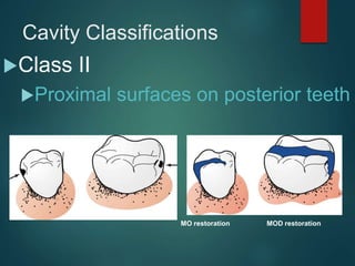 Dental charting, Cavity Classification, Basic Charting Terms | PPTX