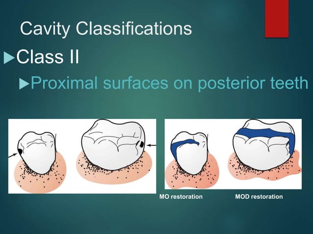 Dental charting, Cavity Classification, Basic Charting Terms | PPTX ...