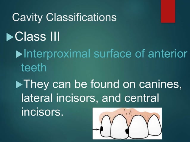 Dental charting, Cavity Classification, Basic Charting Terms | PPTX ...