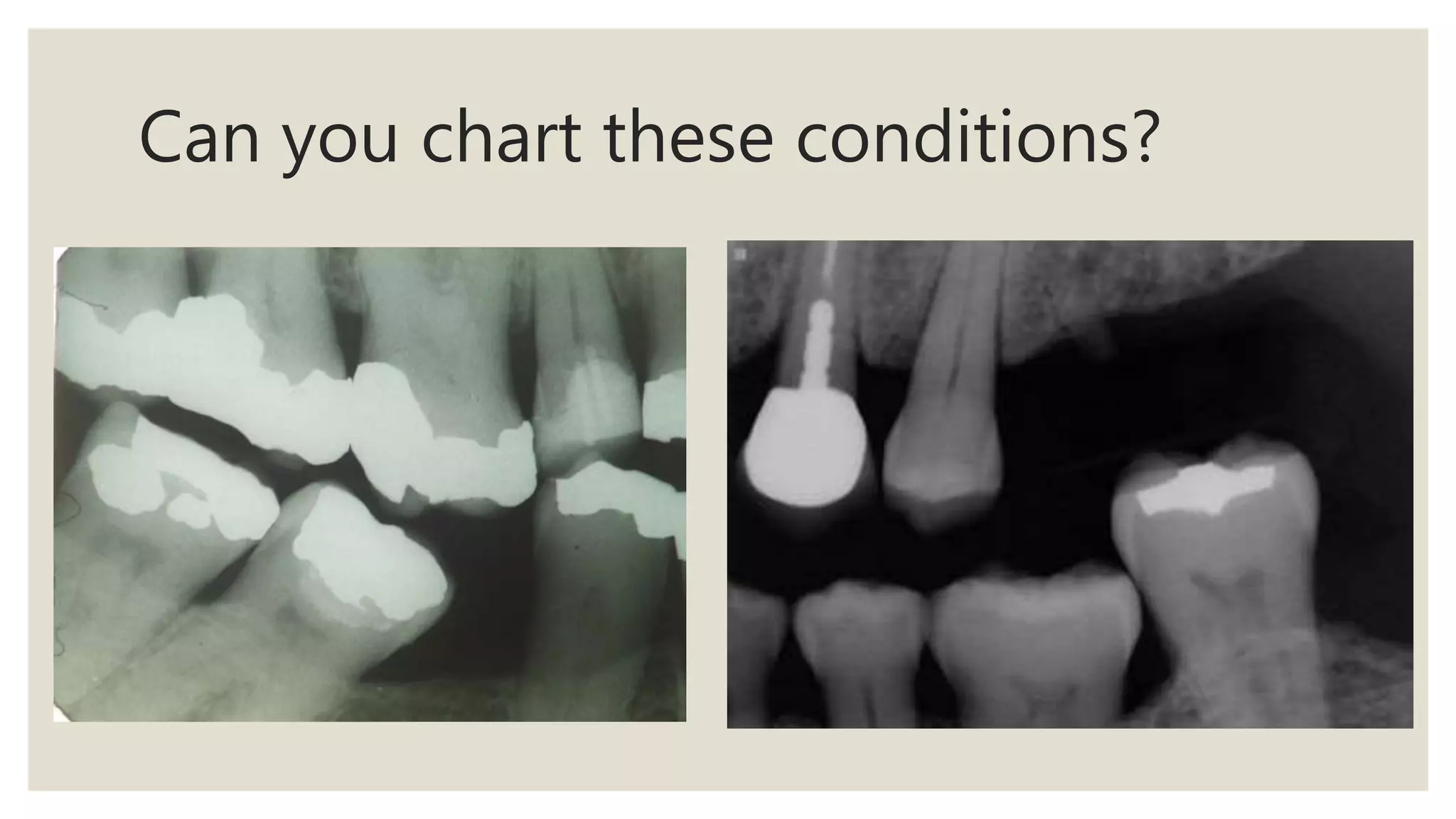 Dental Charting Color Coding And Symbols Class Activity Pptx Dental Health Diseases And