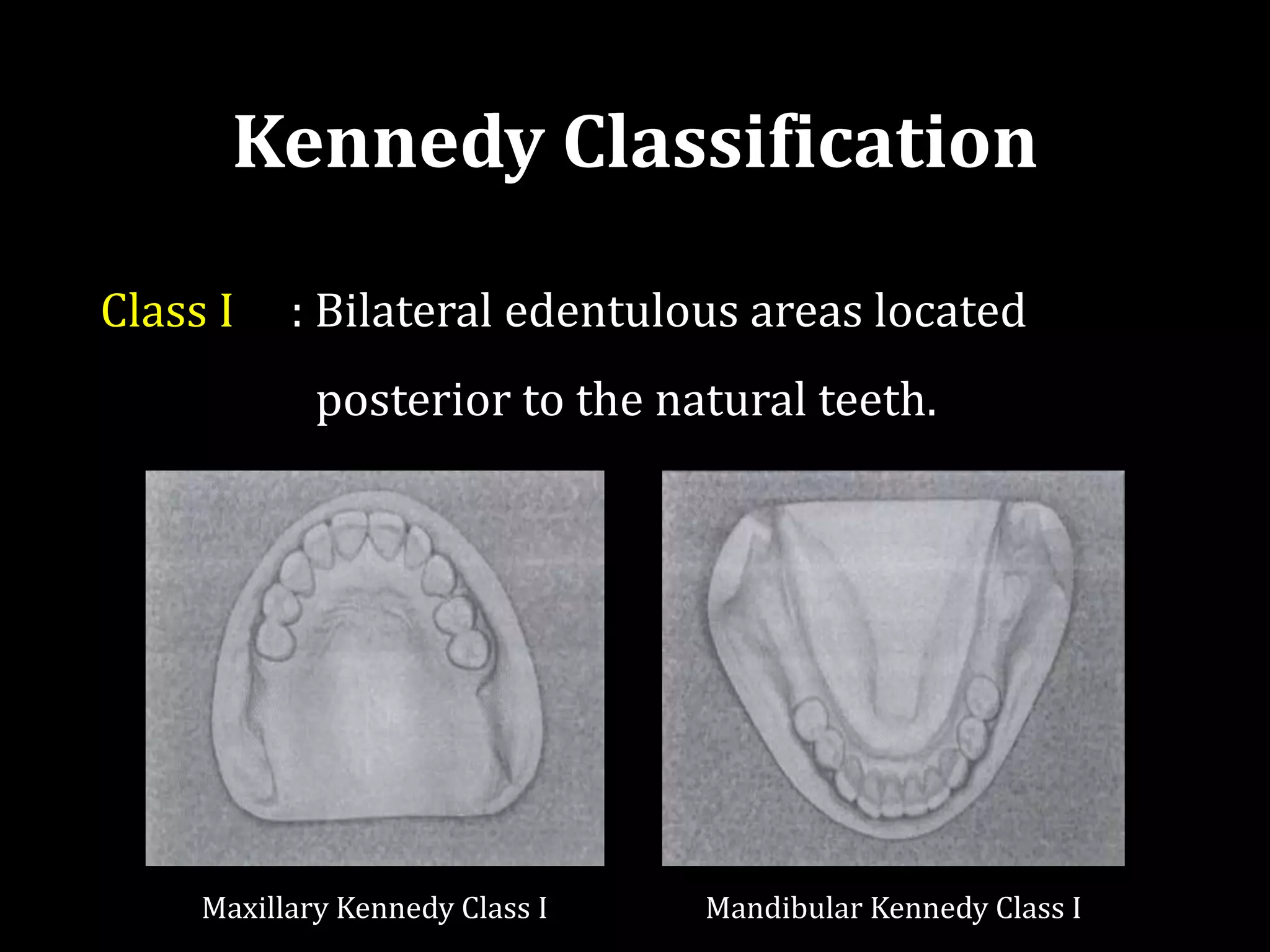 Dental Classification for Removable Partial Denture | PPTX