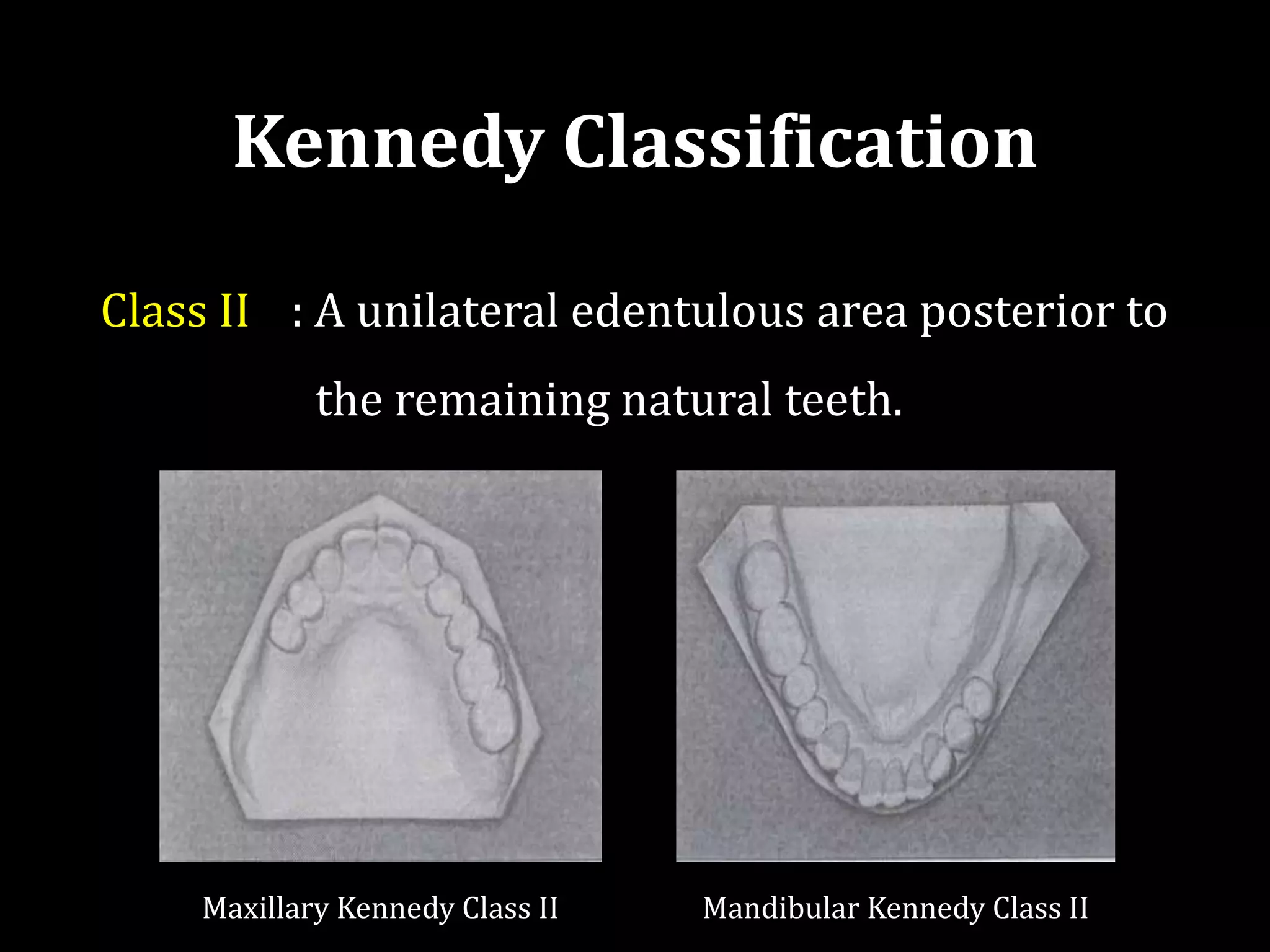 Dental Classification for Removable Partial Denture | PPTX