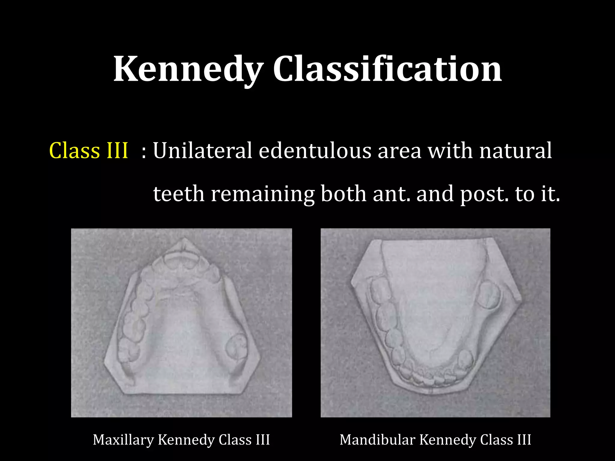 Dental Classification for Removable Partial Denture | PPTX