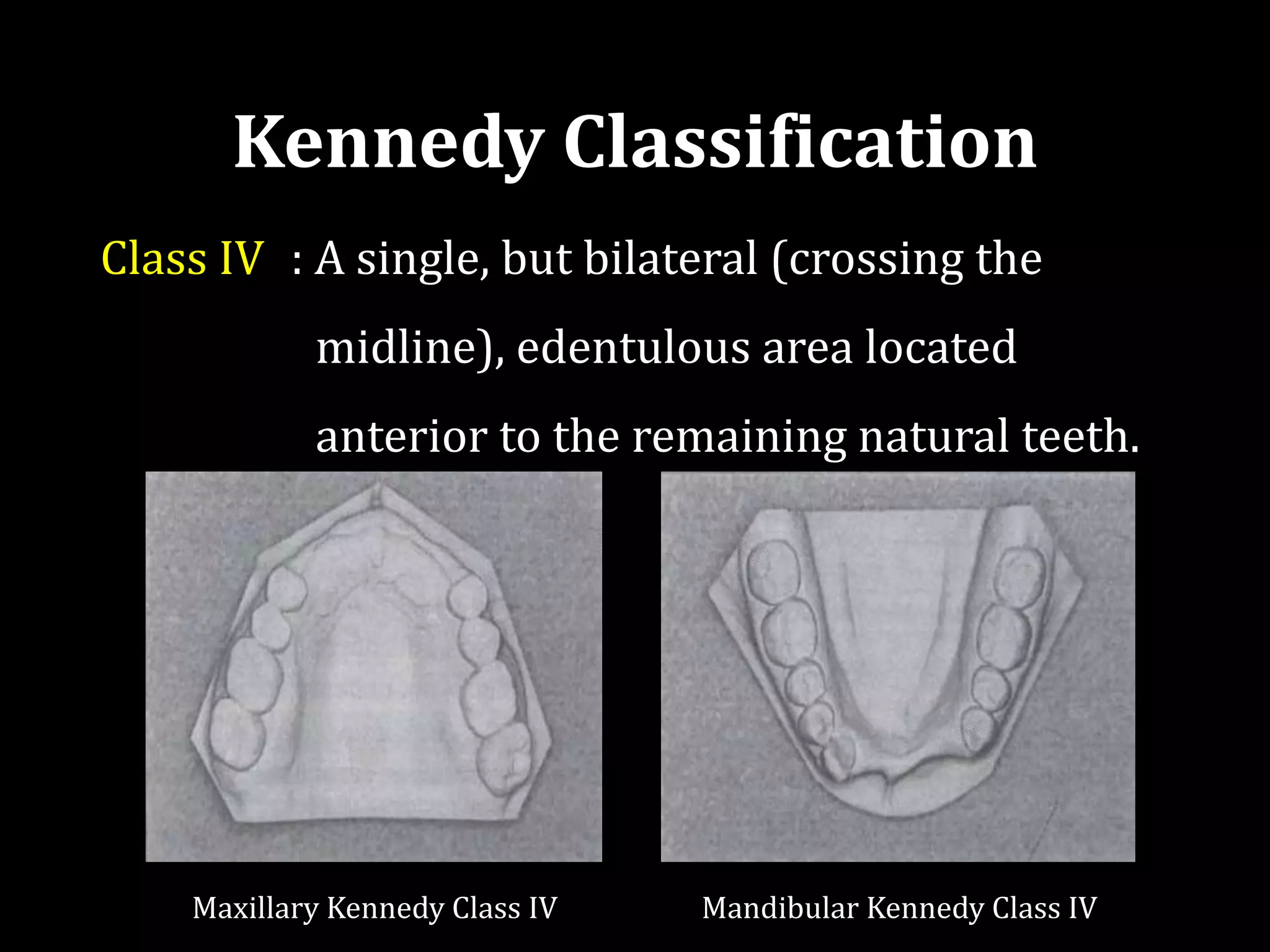 Dental Classification For Removable Partial Denture Pptx