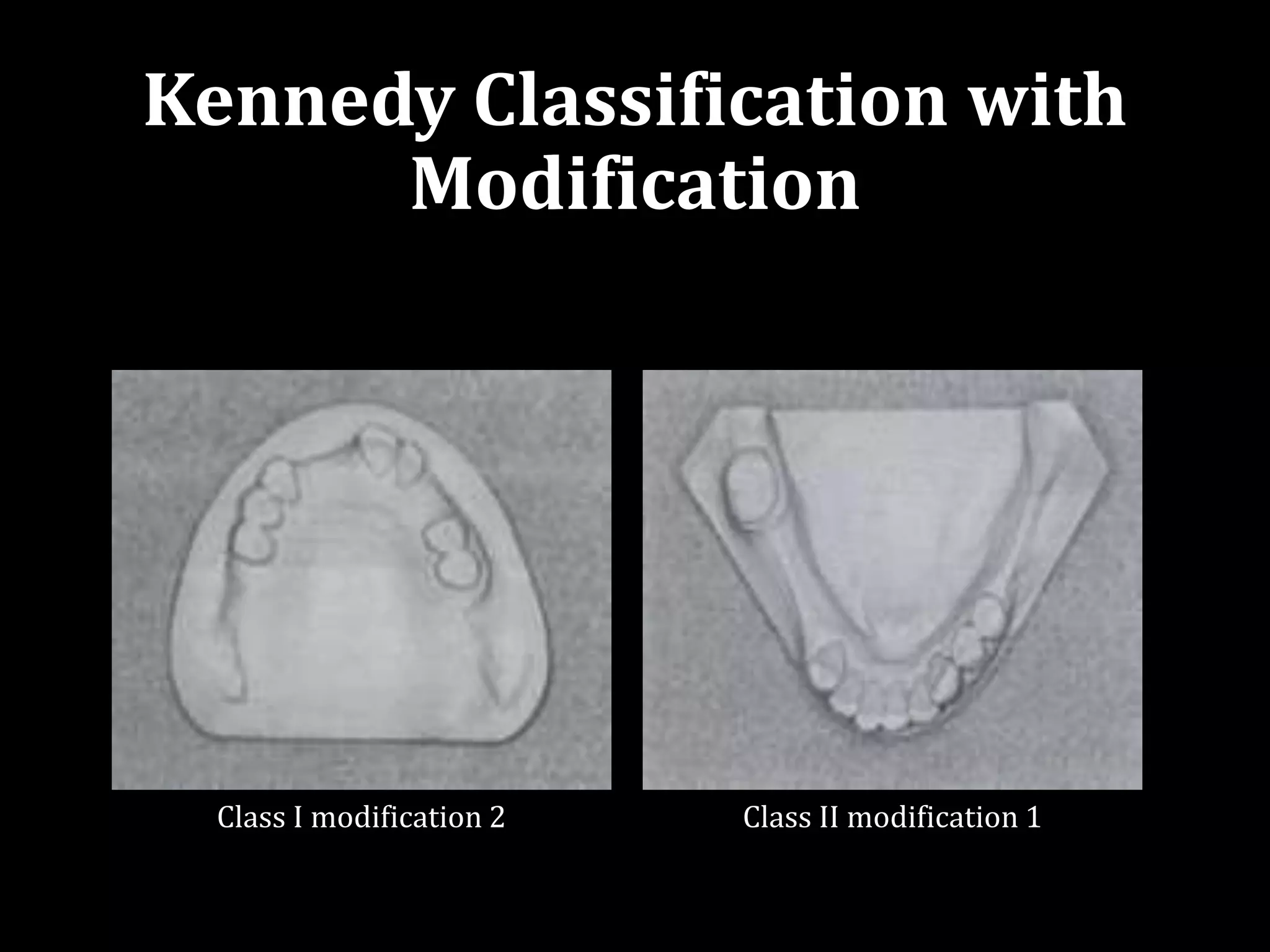 Dental Classification for Removable Partial Denture | PPTX