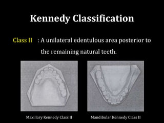 Dental Classification for Removable Partial Denture | PPTX