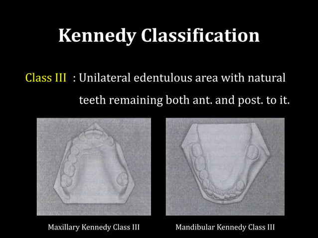 Dental Classification for Removable Partial Denture | PPT