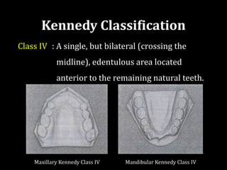 Dental Classification for Removable Partial Denture | PPTX