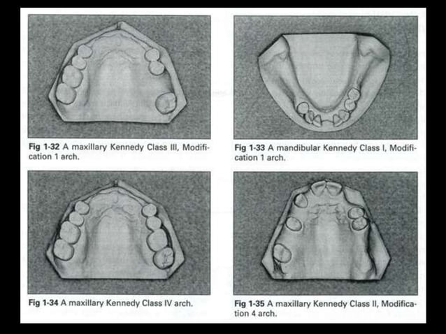 Dental Classification for Removable Partial Denture | PPT