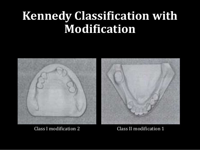 Dental Classification For Removable Partial Denture
