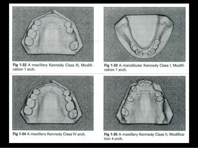 Dental Classification For Removable Partial Denture