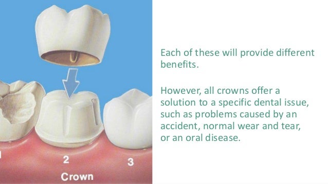 Dental Crown Procedure - What to Expect