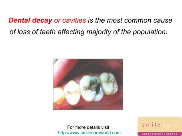 Dental decay and ways to prevent it | PPT | Oral care | Personal Care