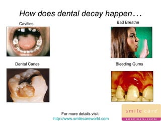 Dental decay and ways to prevent it | PPT