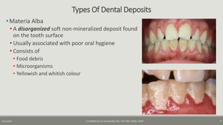 Dental Deposits AMAR.pdfsewarsewarandsew | PDF