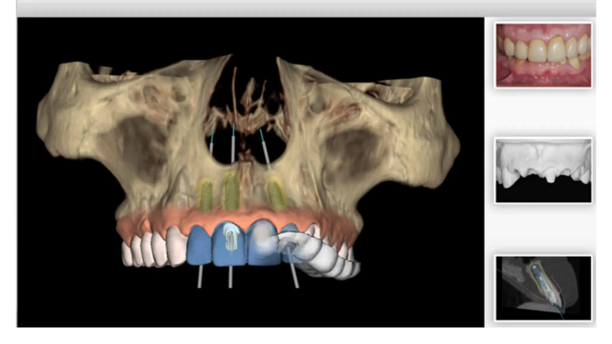 Dental Digital Scanners: Intraoral and Extraoral 3D Scanners | PDF