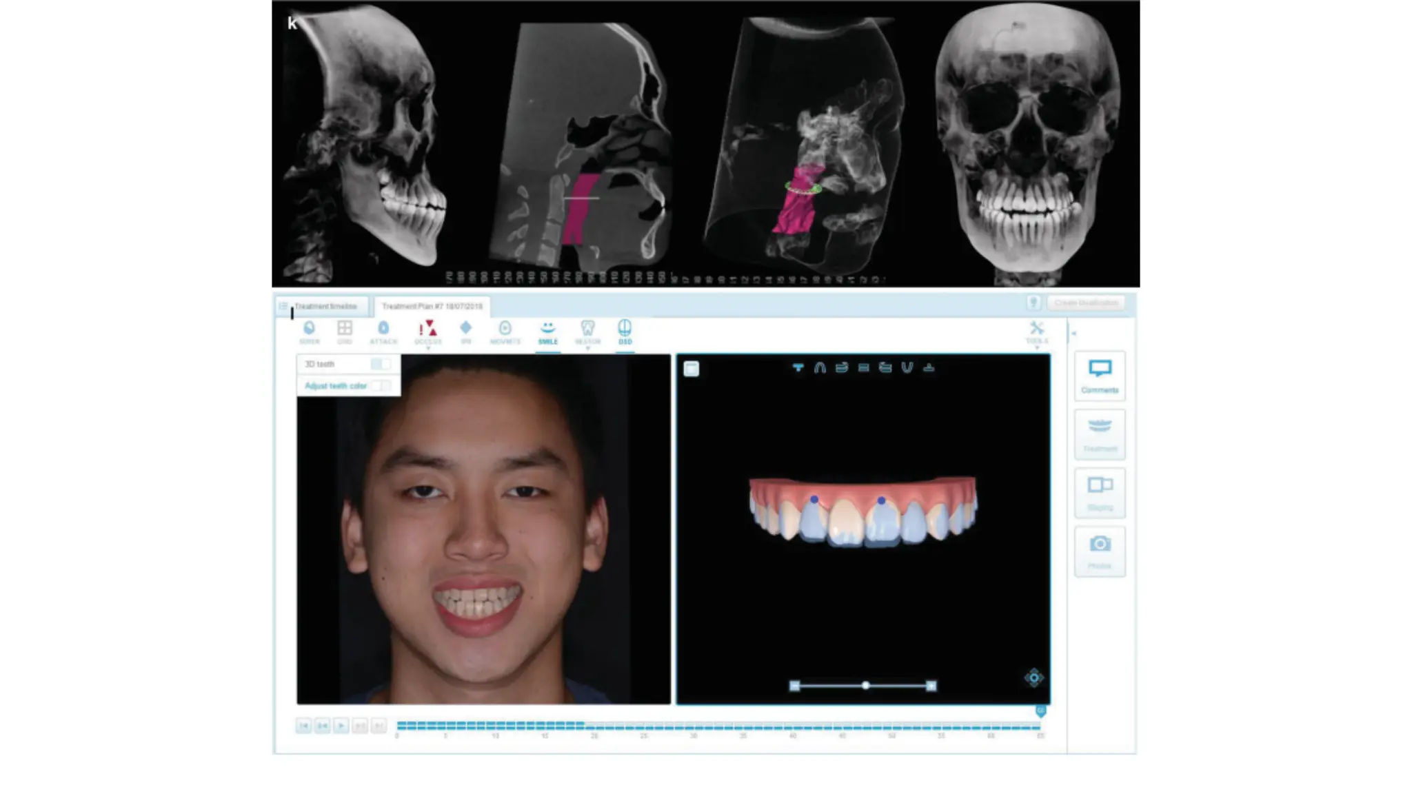 Dental Digital Scanners: Intraoral and Extraoral 3D Scanners | PDF