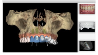Dental Digital Scanners: Intraoral and Extraoral 3D Scanners | PDF