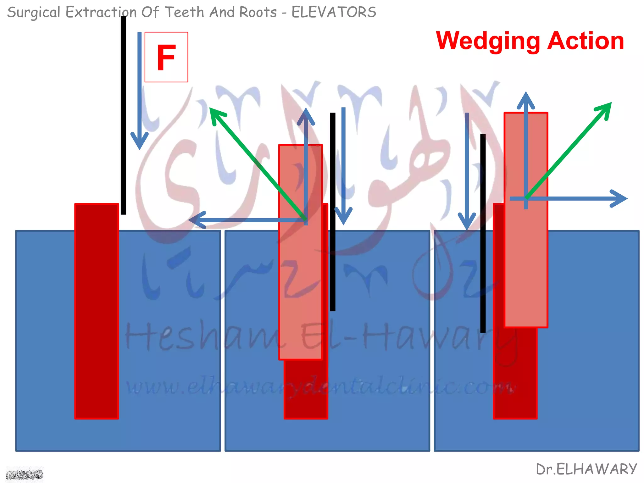 Dental elevators | PPTX