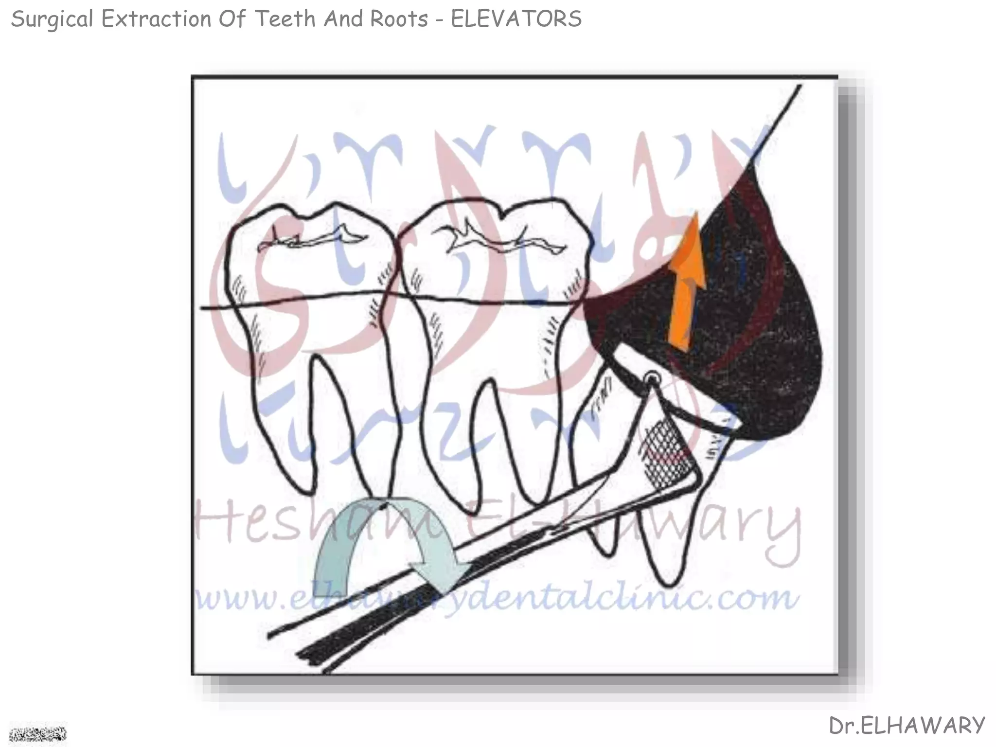 Dental elevators | PPTX