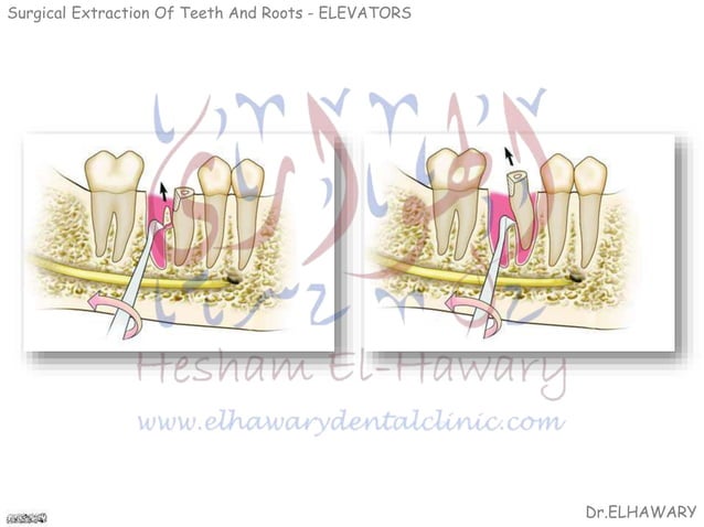 Dental elevators | PPTX | Dental Health | Diseases and Conditions