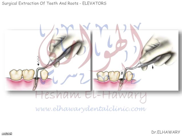 Dental elevators | PPTX | Dental Health | Diseases and Conditions
