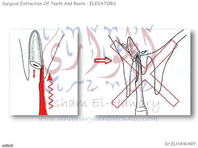 Dental elevators | PPTX | Dental Health | Diseases and Conditions