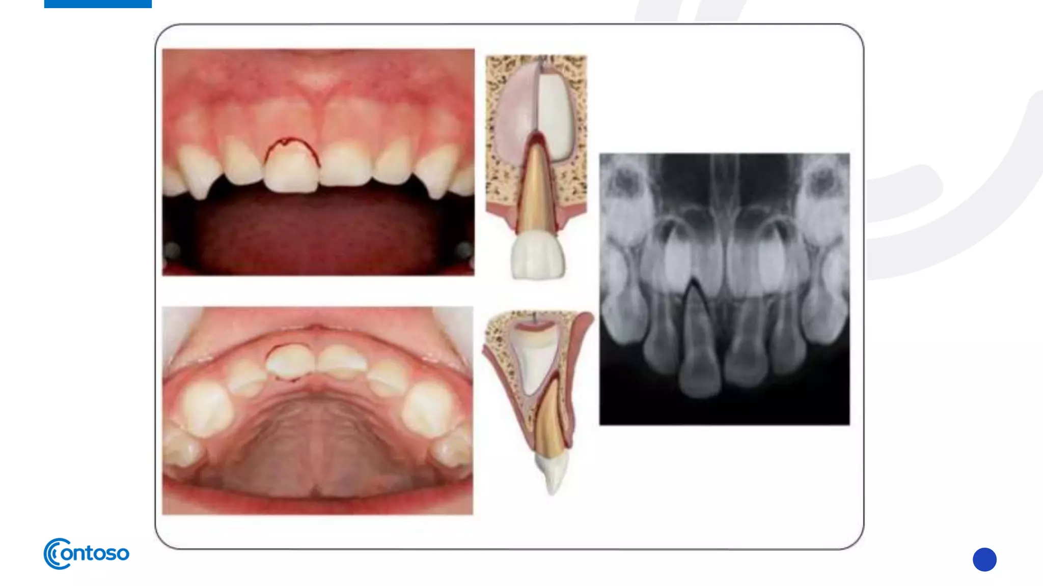 Dental Extrusion.pptx