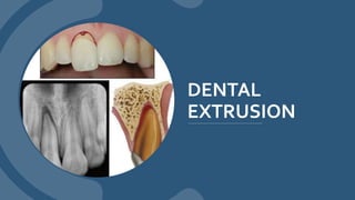 Dental Extrusion.pptx