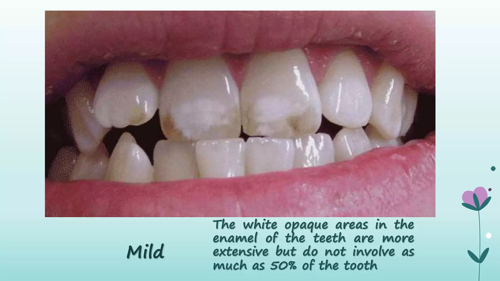Dental Fluorosis | PPTX
