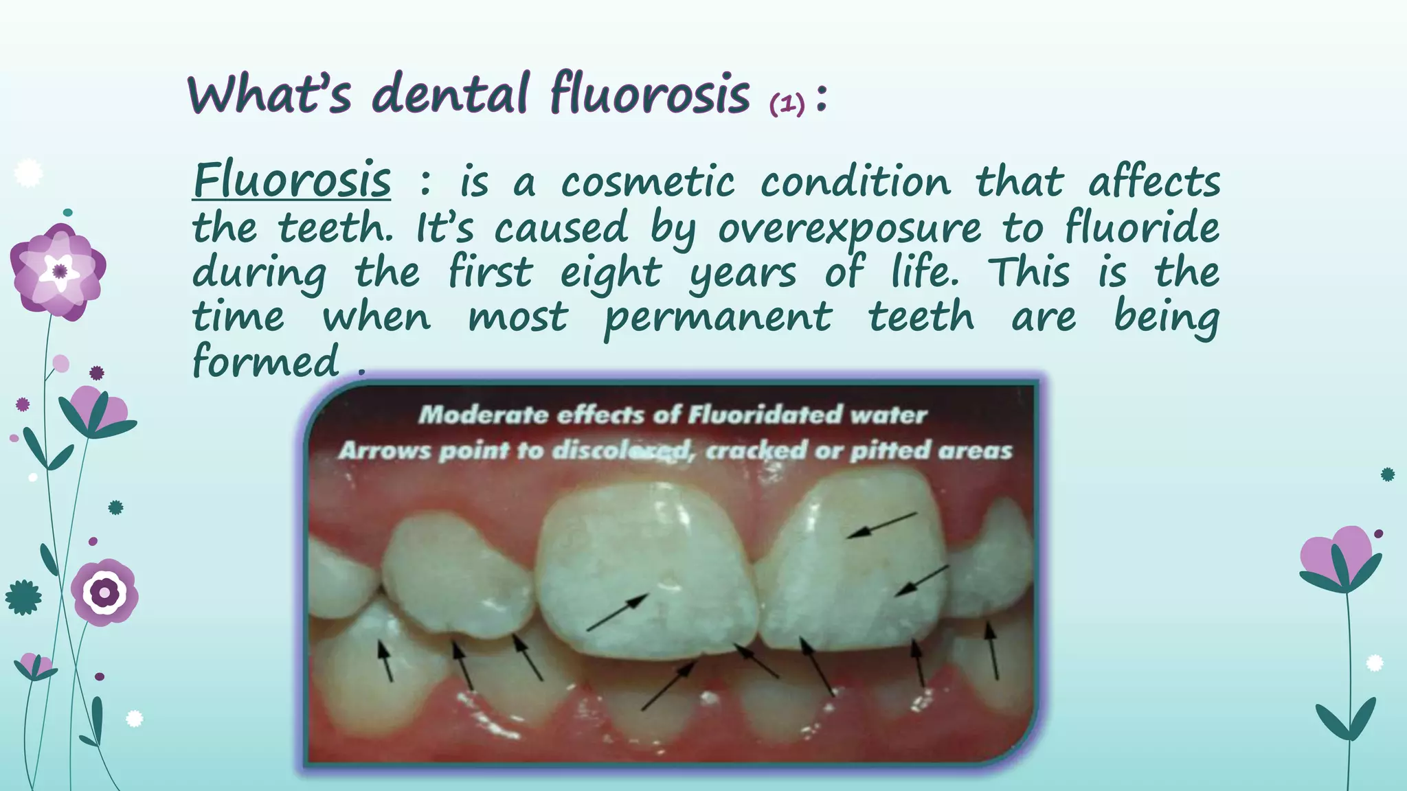 Dental Fluorosis | PPTX