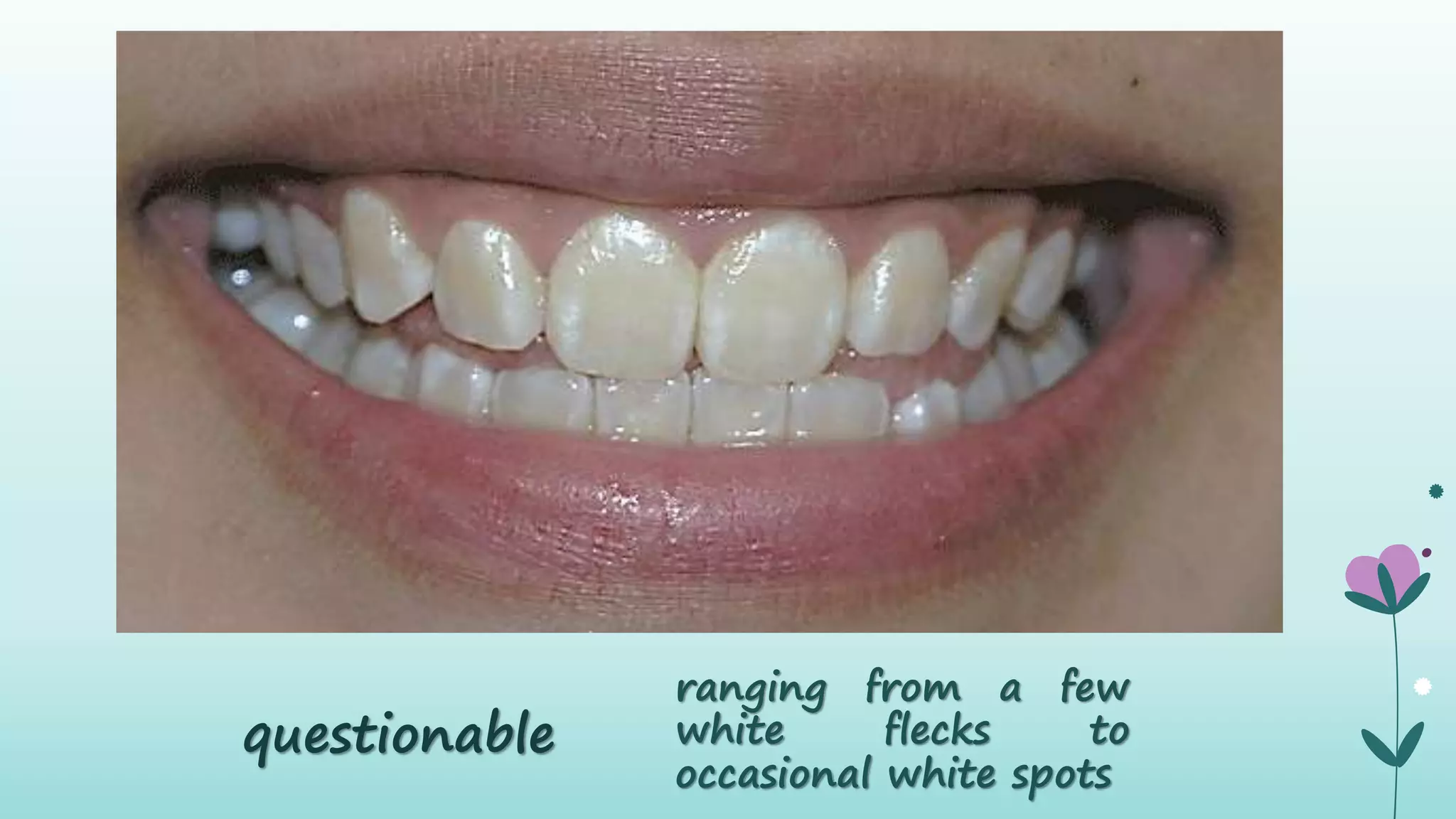 Dental Fluorosis | PPTX