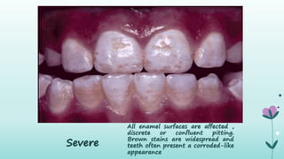 Dental Fluorosis | PPTX
