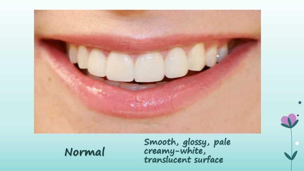 Dental Fluorosis dental-fluorosis