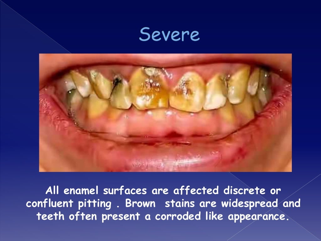 Overview On Dental Fluorosis Overview On Dental Fluorosis