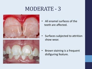 Dental fluorosis. | PPTX