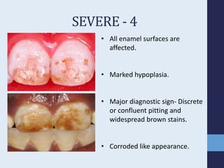 Dental fluorosis. | PPTX