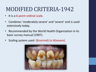 Dental fluorosis. | PPTX | Dental Health | Diseases and Conditions