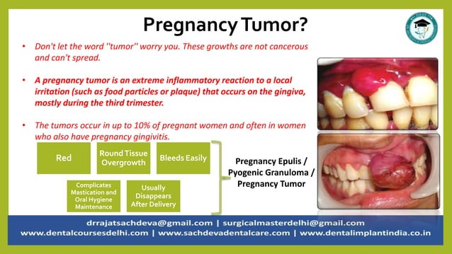 Dental health during pregnancy and how to avoid common dental problems ...