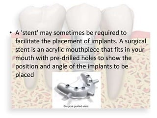 Dental implant | PPSX