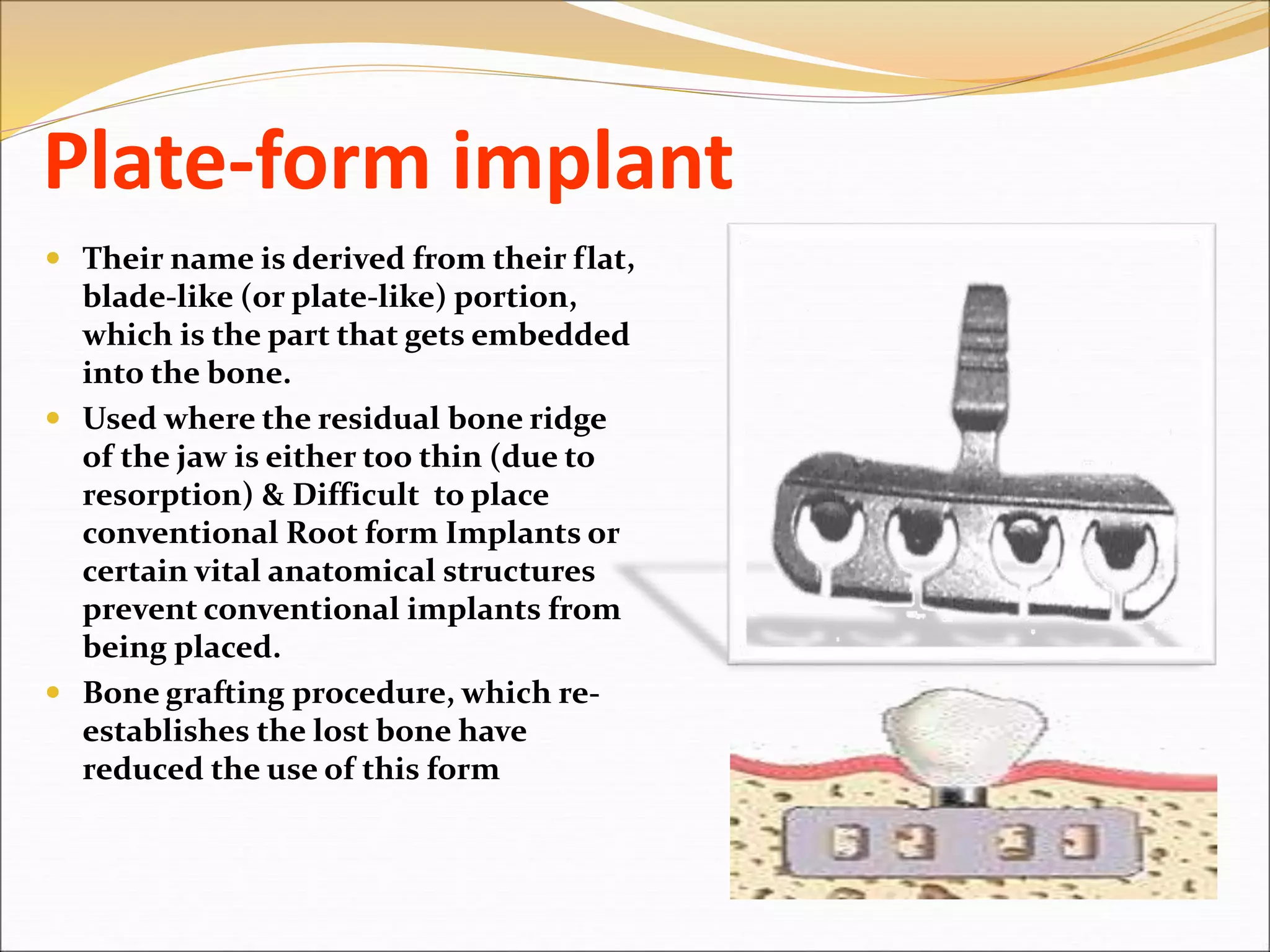 Dental Implant.ppt
