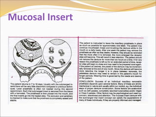 Dental Implant.ppt