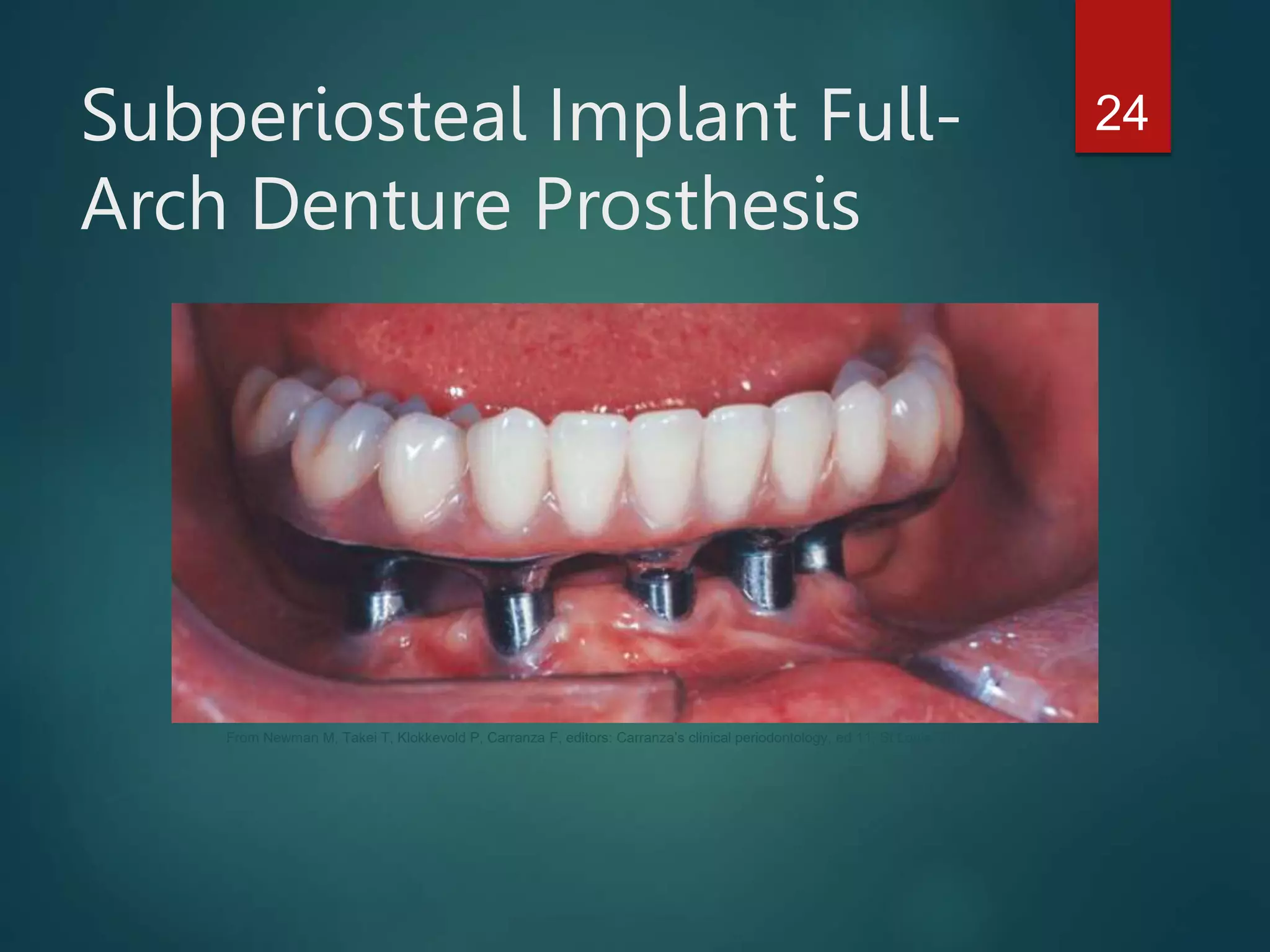 Dental implant.ppt