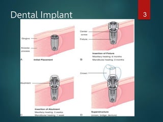 Dental implant.ppt