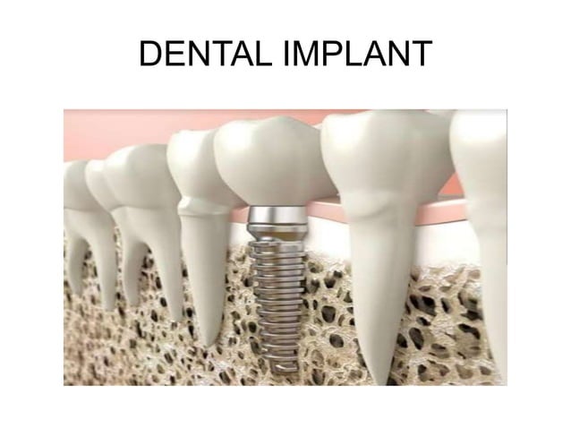 dental implant.ppt