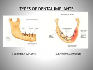 Dental implant | PPTX | Dental Health | Diseases and Conditions