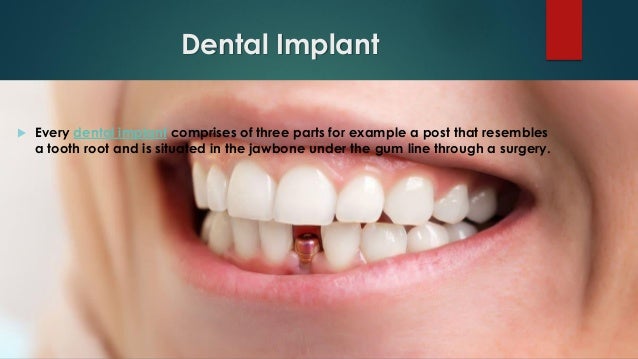 Dental Implant Advantages and Disadvantages.pdf Dental Implant Advantages and Disadvantages.pdf