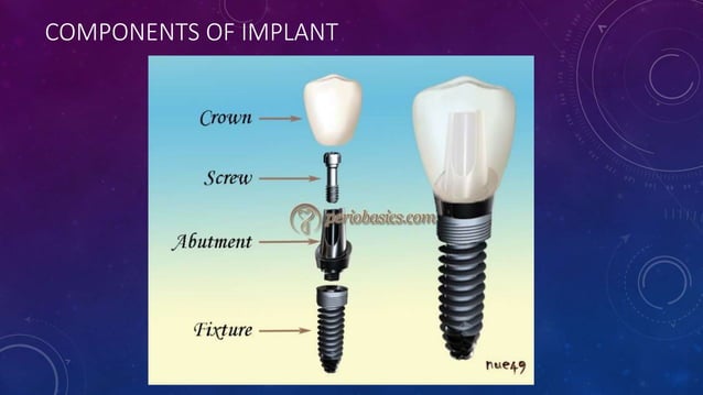 Dental implant components .pptx | Dental Health | Diseases and Conditions