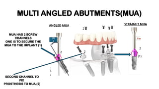 DENTAL IMPLANT COMPONENTS in brief - a short summary | PPTX